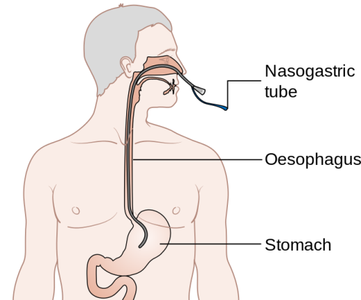 Nasogastric tube - Being discharged with a nasogastric tube :: The ...